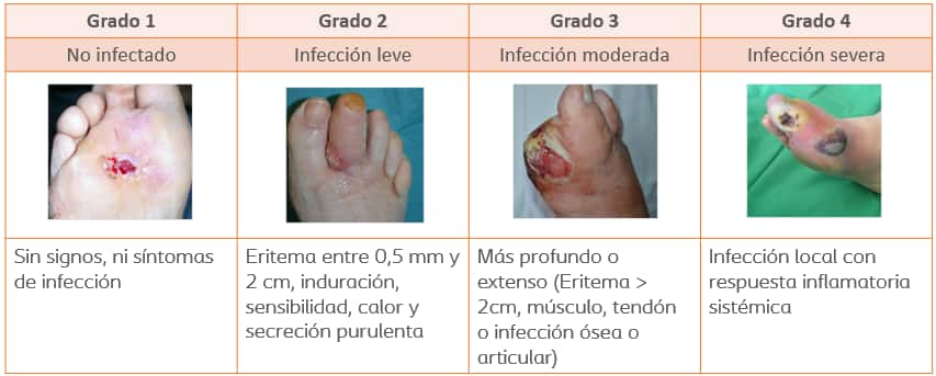 Cómo tratar una úlcera de pie diabético infectada