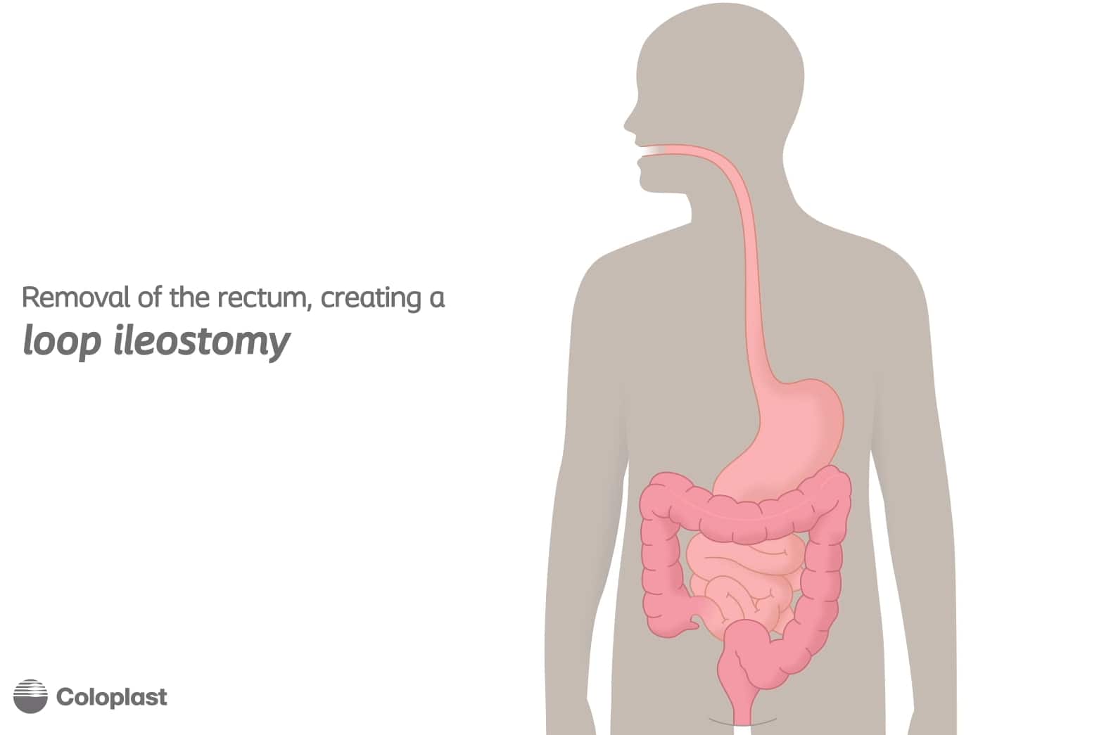 Ileostomía en asa y bolsa rectal